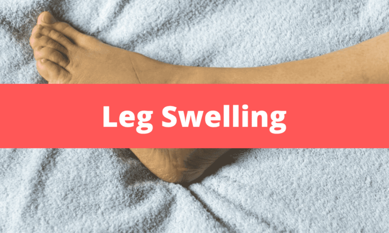 Leg Swelling Medical Junction