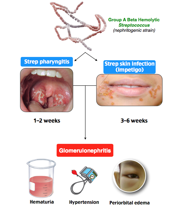 Acute Post Streptococcal Glomerulonephritis Medical Junction Acute Post Streptococcal Glomerulonephritis Medical Junction