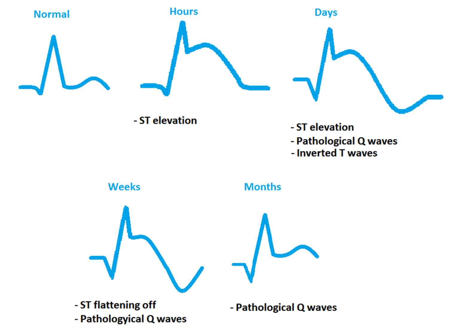 Acute Myocardial Infarction | Medical Junction