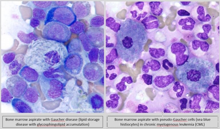 Chronic Myeloid Leukemia (CML) | Medical Junction