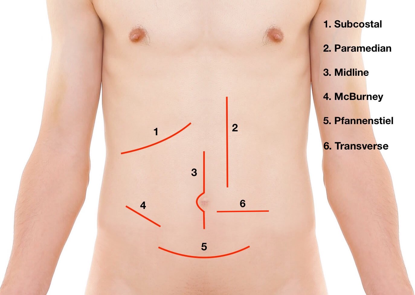 Abdominal Incisions Medical Junction Abdominal Incisions Medical Junction